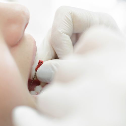 Pourquoi dévitaliser une dent